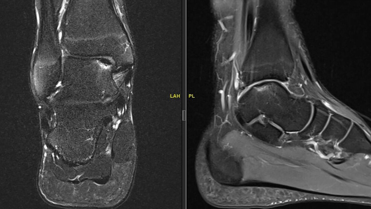 Osteochondrosis Dissecans Talus Hock Osteochondritis Dissecans (OCD)