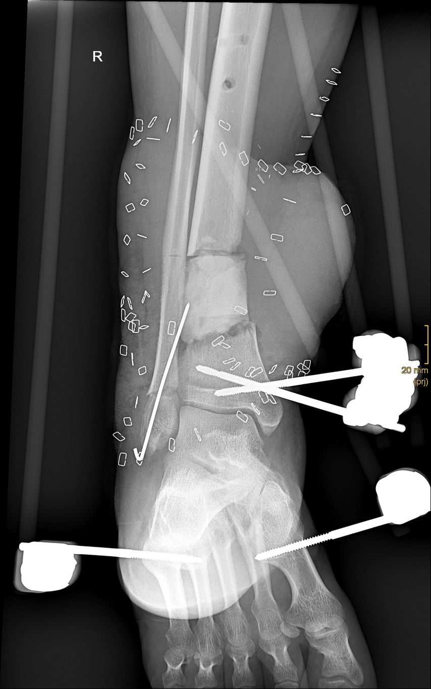 Therapie bei schweren Infektionen mit multiresistenten Erregern ...