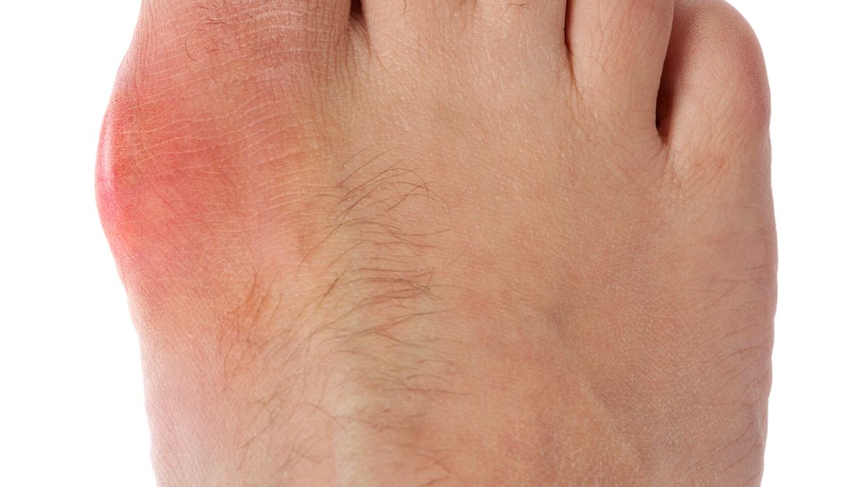 Die Behandlung des akuten Gichtanfalls - Allgemeine Innere Medizin ...