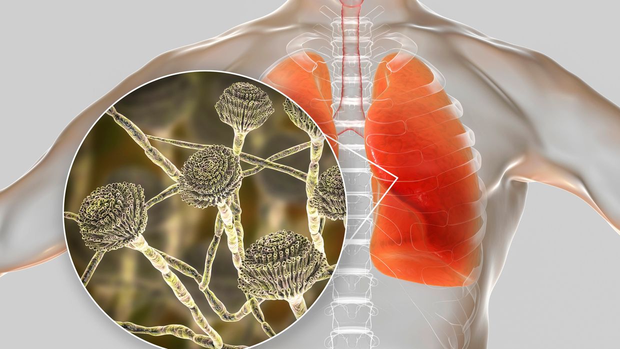Diagnostik invasiver Mykosen - Infektiologie - Universimed - Medizin im ...