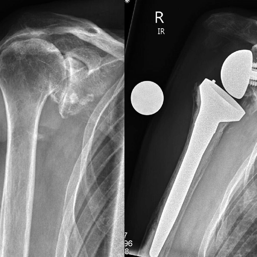 Lateralisierung bei inverser Endoprothetik der Schulter - Orthopädie ...
