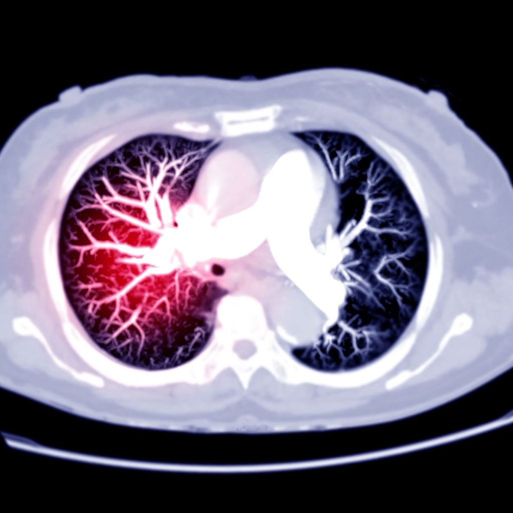 Akute Pulmonalembolie: Therapieentscheidung zwischen Nutzen und Blutun ...