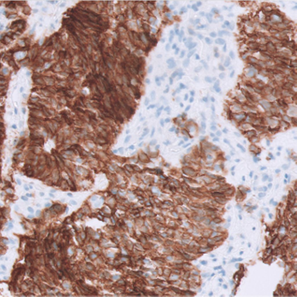 Potential applications of IHC to aid pathological assessment of SCLC ...