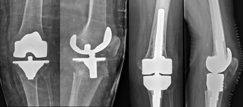 Therapieoptionen bei periprothetischen distalen Femur- und proximalen ...