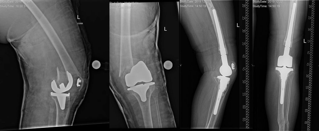 Therapieoptionen bei periprothetischen distalen Femur- und proximalen ...
