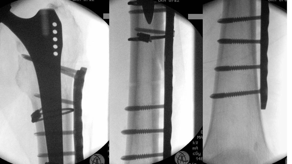 Osteosynthese versus Prothese bei der Vancouver-B2-Fraktur - Orthopädie ...