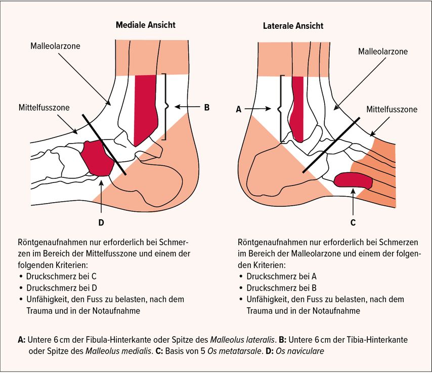 Was ist bei einer Sprunggelenksdistorsion zu beachten? - Allgemeine ...