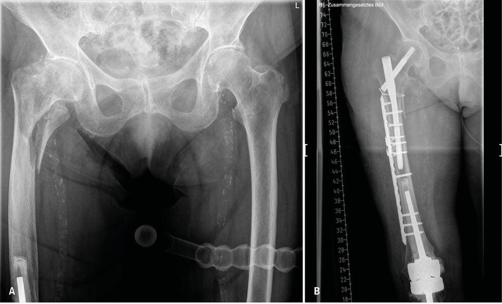 Management der interkalären Fraktur bei liegender Knie- und Hüft-TEP ...