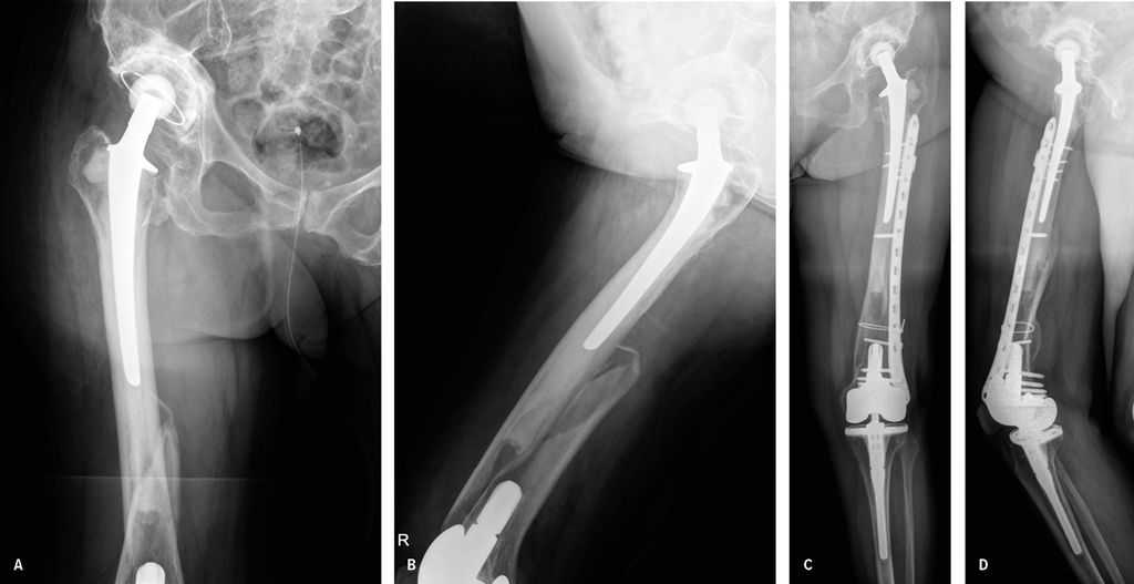 Management der interkalären Fraktur bei liegender Knie- und Hüft-TEP ...