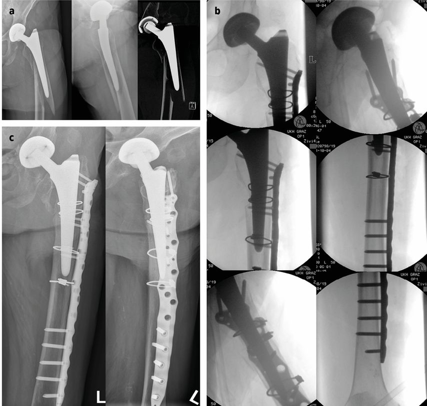 Osteosynthese versus Prothese bei der Vancouver-B2-Fraktur - Orthopädie ...