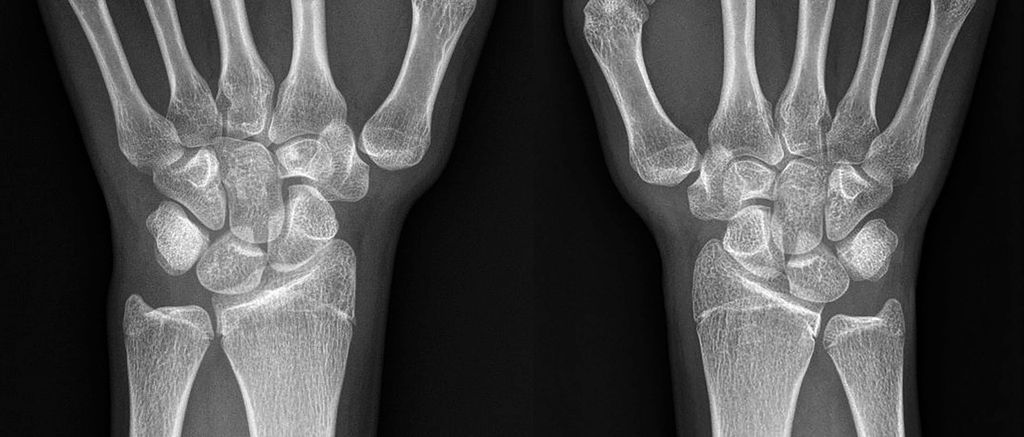 Die habituelle CMC1-Instabilität des Jugendlichen und jungen Erwachsen ...