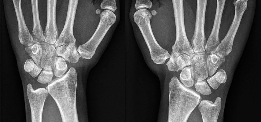 Die habituelle CMC1-Instabilität des Jugendlichen und jungen Erwachsen ...