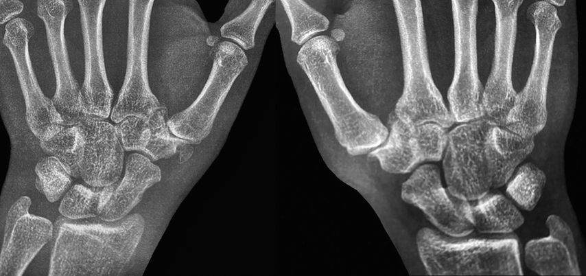 Die habituelle CMC1-Instabilität des Jugendlichen und jungen Erwachsen ...