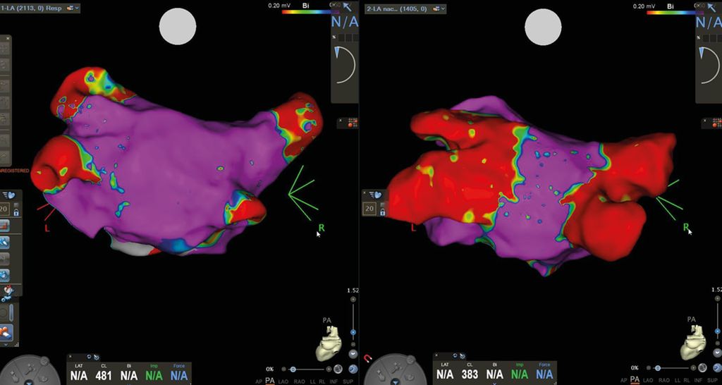 Innovationen in der Katheterablation von Vorhofflimmern - Kardiologie ...