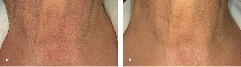 Fraktionierte Techniken in der prozeduralen Dermatologie - Plastische ...