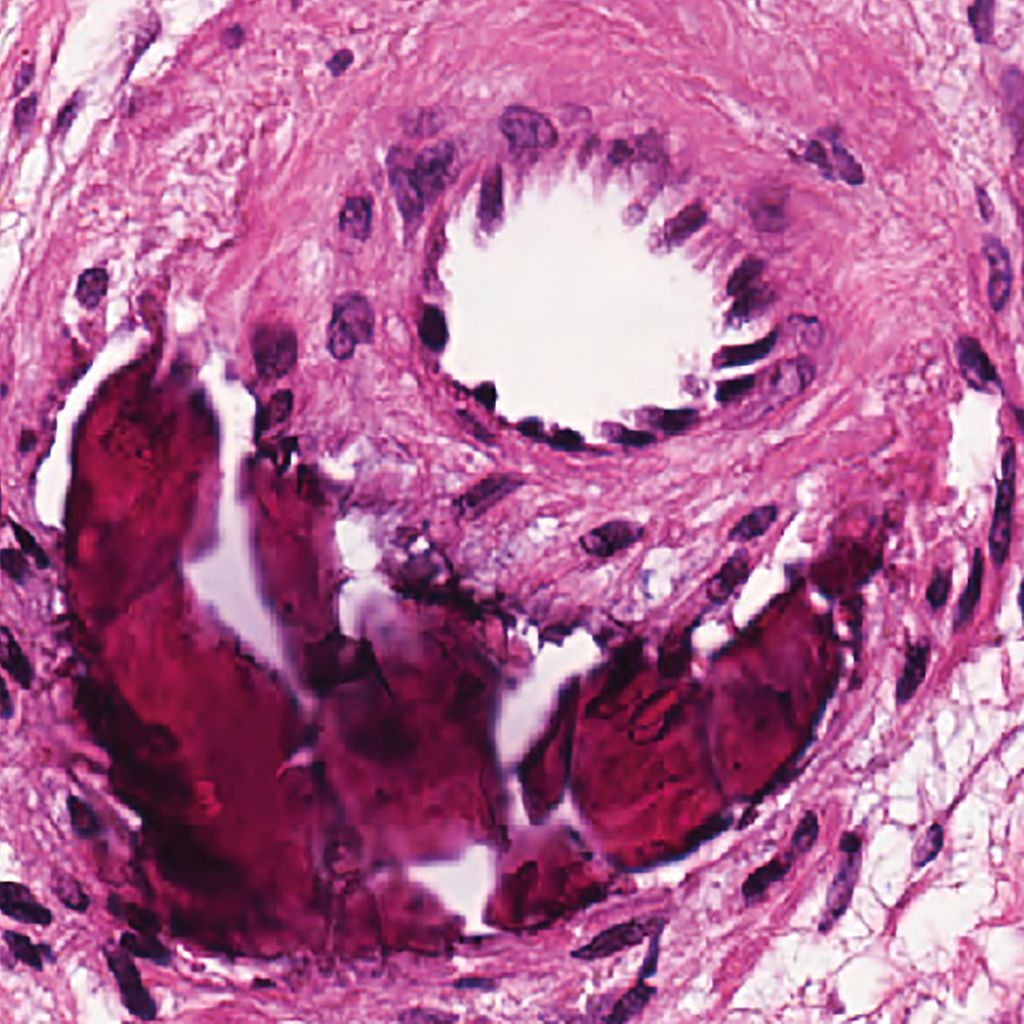 Abklärung und Therapie bei arteriolopathischen Ulzera - Dermatologie ...