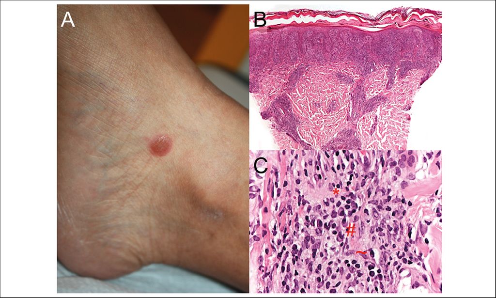 Dermatopathologie als Partner der Klinik für herausfordernde Läsionen ...