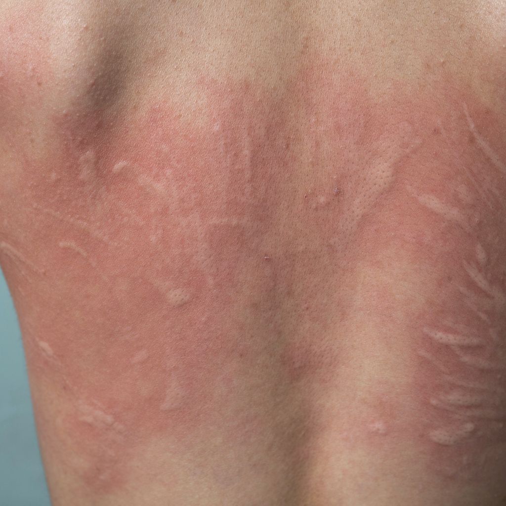 Urtikaria: Was gibt es Neues? - Dermatologie - Universimed - Medizin im ...