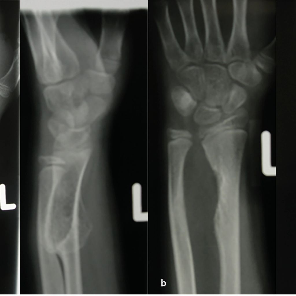 Die häufigsten Knochentumoren der oberen Extremität im Kindes- und Jug ...