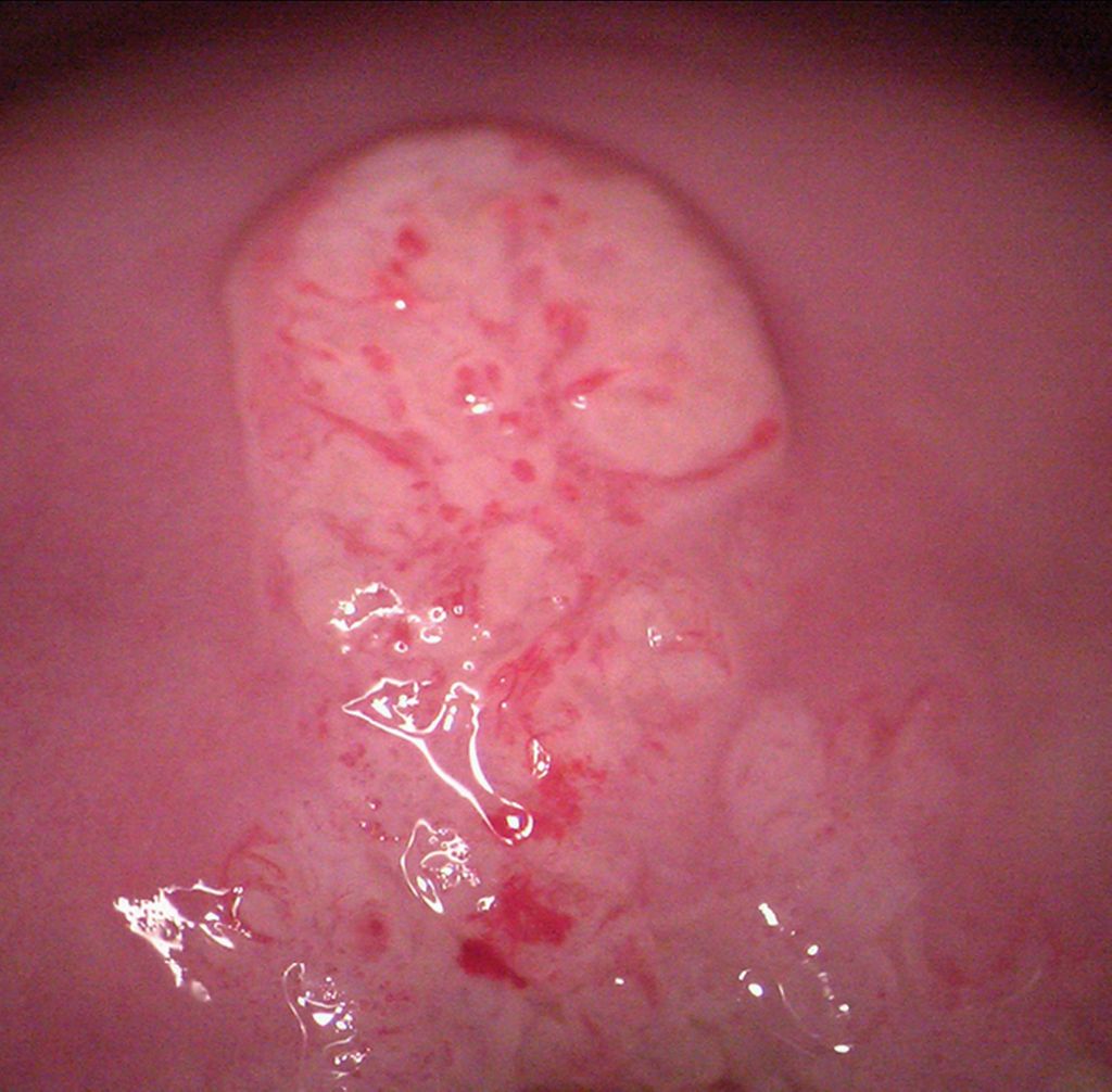 Neues zur Therapie des Zervixkarzinoms - Gynäkologie & Geburtshilfe ...