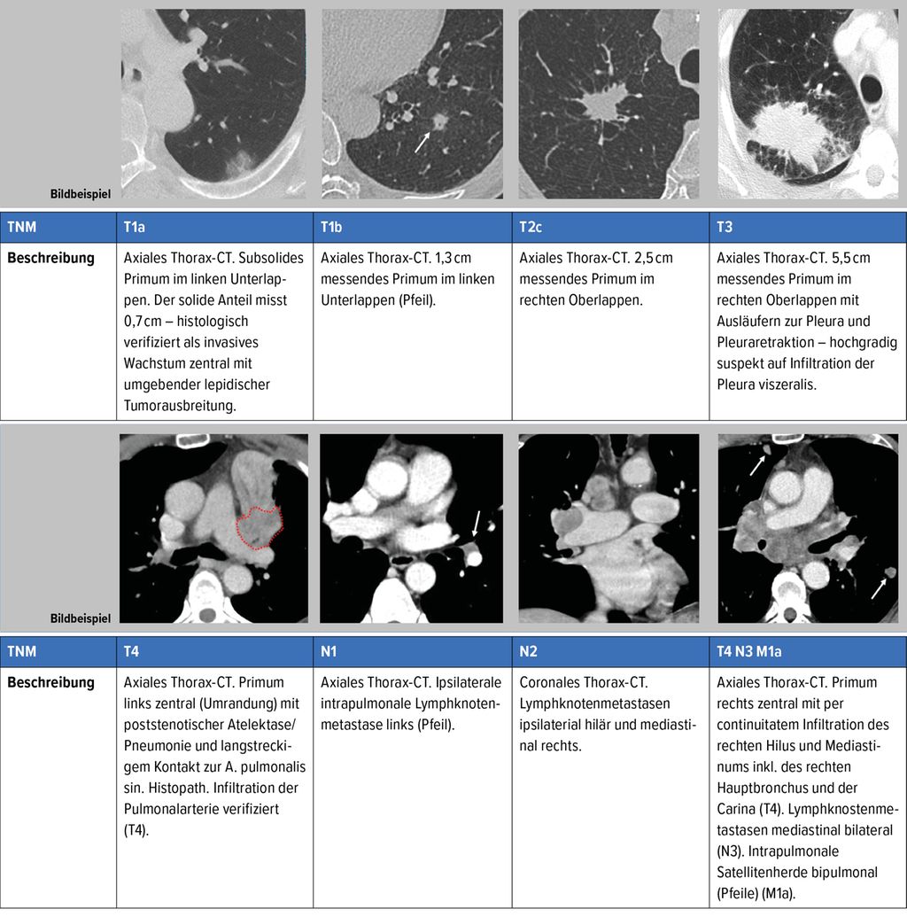 Staging Lungenkarzinom – die radiologische Perspektive - Onkologie ...