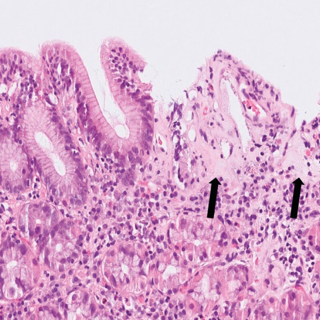 La gastrite collagène – une forme rare de gastrite - Médecine interne ...