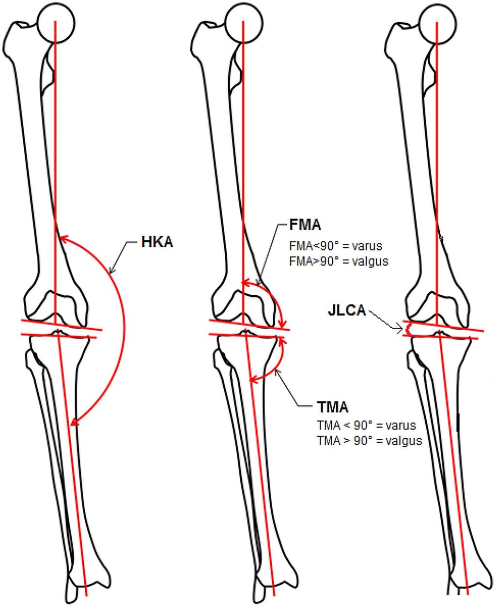 Koronales Alignment in der totalen Knieendoprothetik - Orthopädie ...