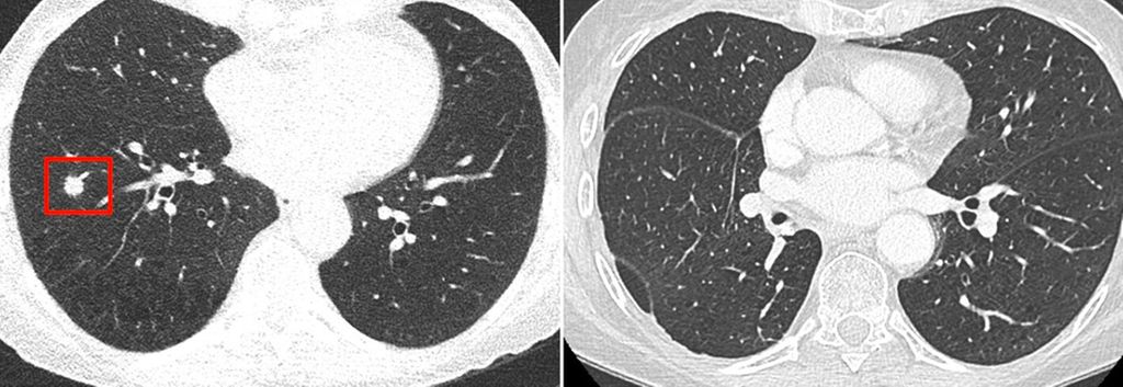 Dépistage du cancer du poumon – évolutions actuelles en Suisse et appr ...