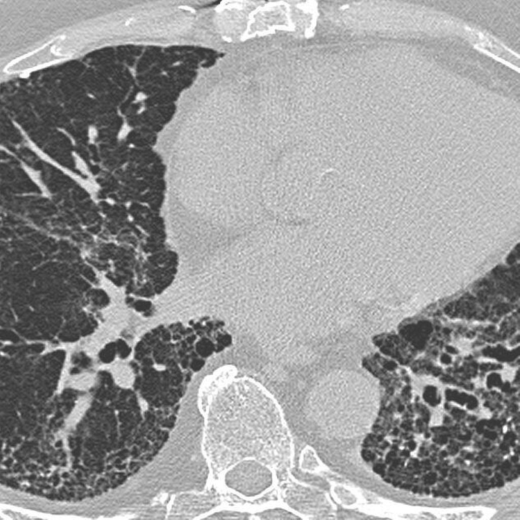 20 Jahre idiopathische pulmonale Fibrose - Pneumologie - Universimed ...