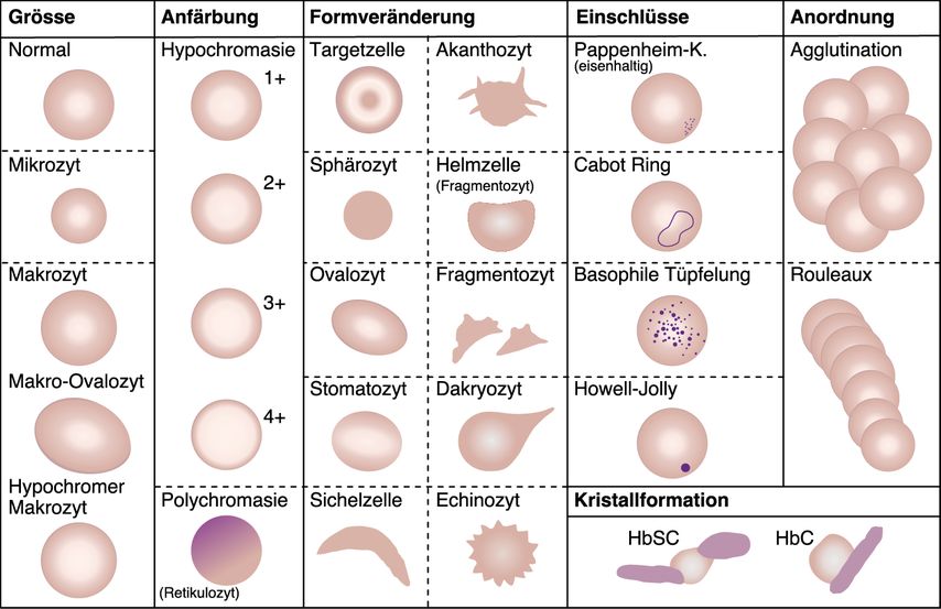 Interpretation des mikroskopischen Blutbildes - Allgemeine Innere ...