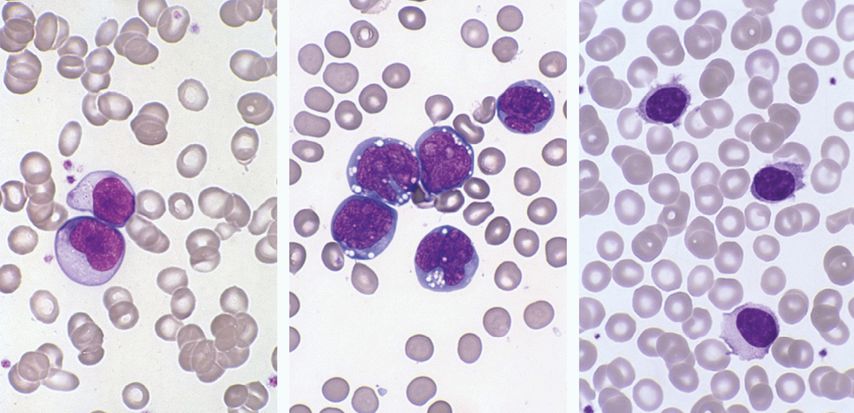 Interpretation des mikroskopischen Blutbildes - Allgemeine Innere ...