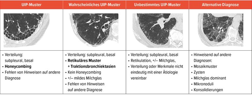 Was müssen Pneumologen bei der HRCT beachten? - Pneumologie ...