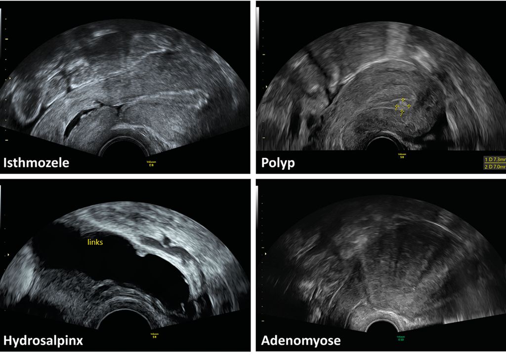 Antwort Kann man Myome im Ultraschall sehen? Weitere Antworten – Kann ...