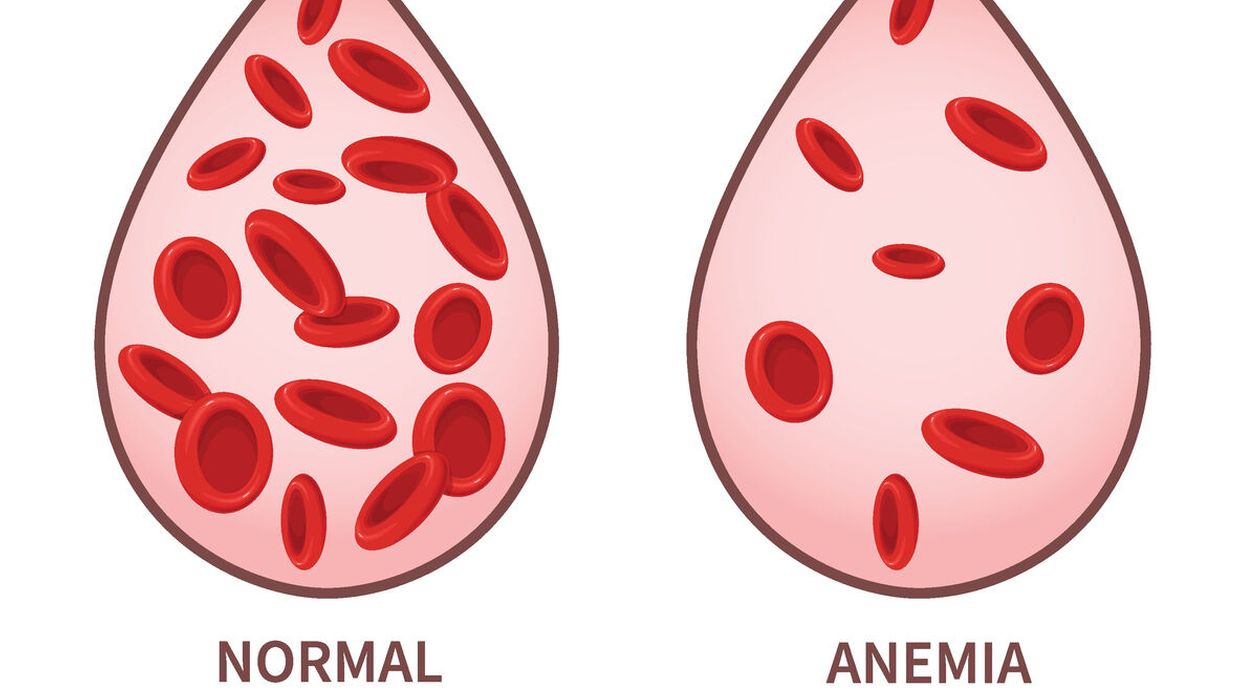 Anémie chronique inexpliquée, quelle est la marche à suivre? - Contenu ...