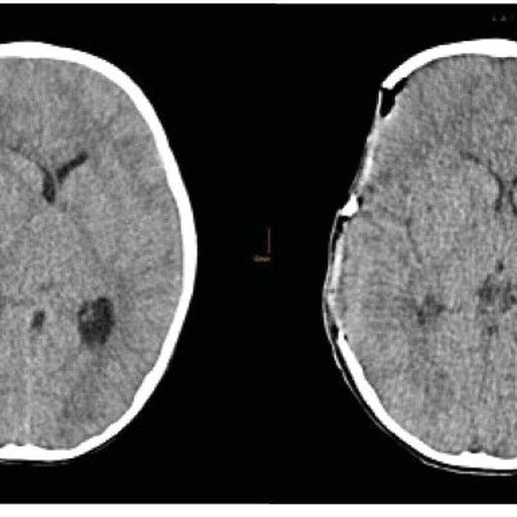 Traumatische Hirnblutungen im Kindes- und Jugendalter: Management und ...