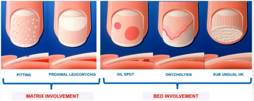 Aktuelles zum Management der Nagelpsoriasis - Dermatologie ...