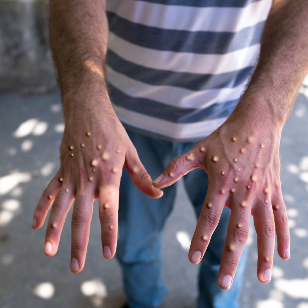 Aktuelles zu den Affenpocken - Dermatologie - Universimed - Knowledge ...