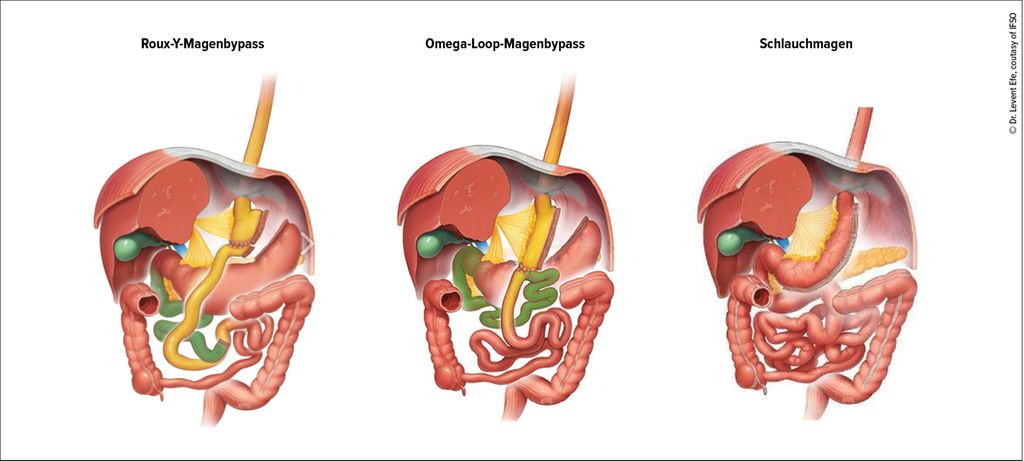 Ausblick: Therapie der Adipositas - Diabetologie & Endokrinologie ...
