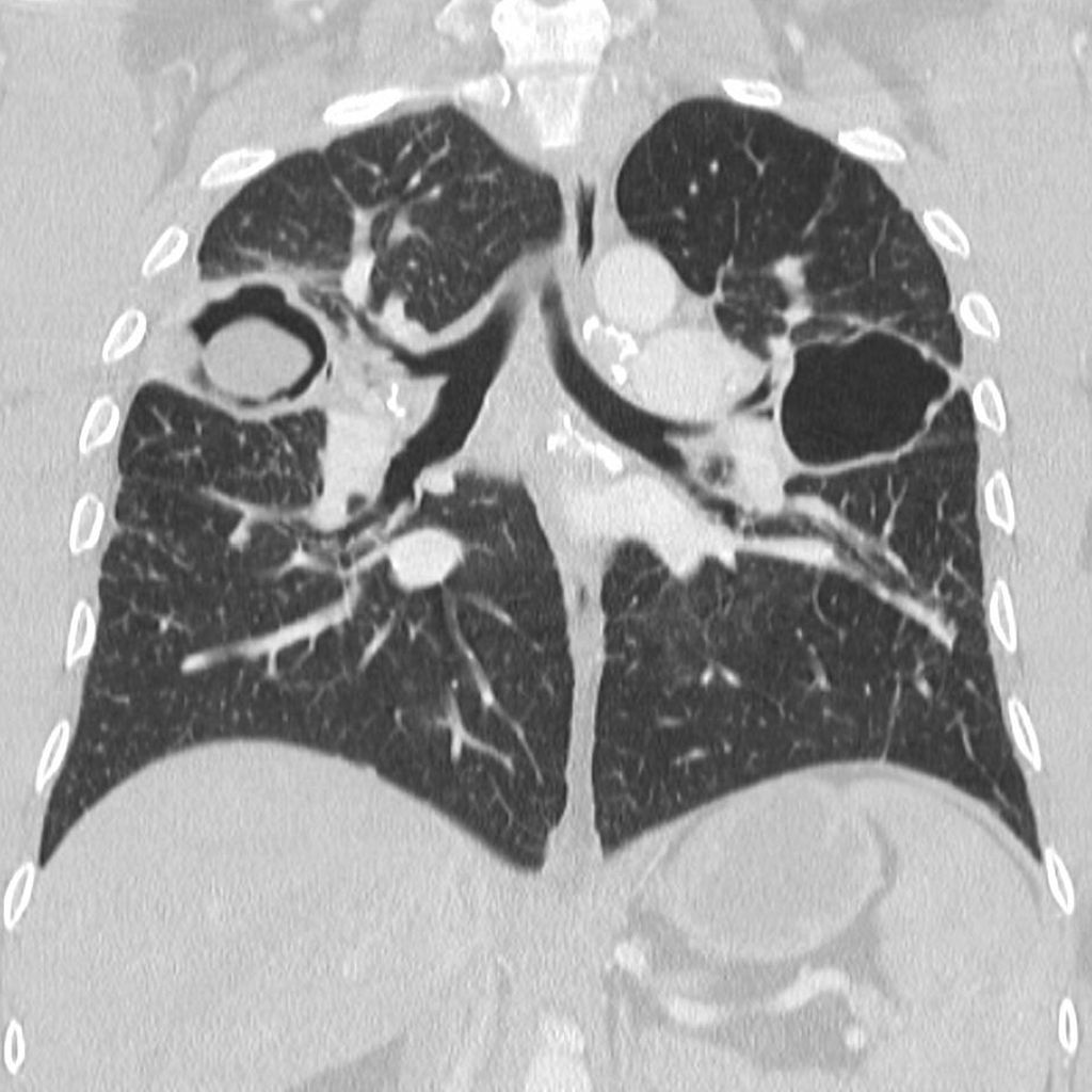 Sarkoidose: die Fortschritte der letzten 20 Jahre - Pneumologie ...