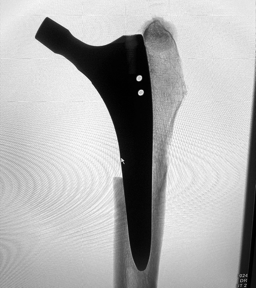 Die intraoperative Clamshell-Fraktur und ihre Therapie – eine biomecha ...