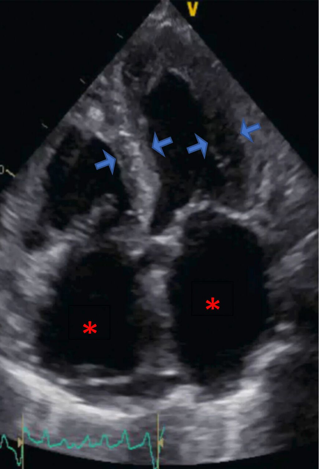 Amyloidose als Ursache von Herzinsuffizienz mit erhaltener EF ...