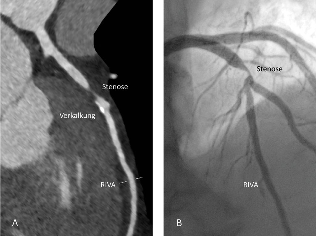 Nichtinvasiver Nachweis bzw. Ausschluss einer koronaren Herzkrankheit ...