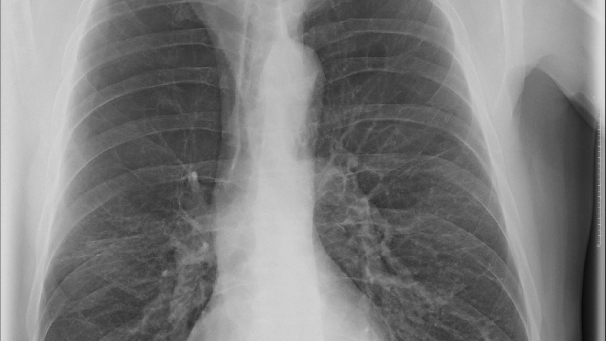 Die Lebensqualität bei Lungenemphysem verbessern - Pneumologie ...