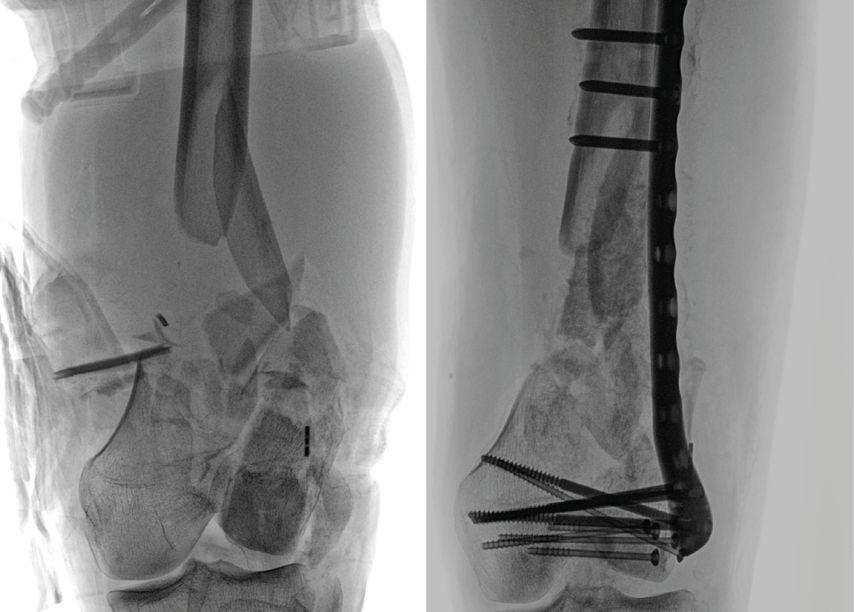 Biphasic Plate: ein neues Konzept der Osteosynthese - Orthopädie ...
