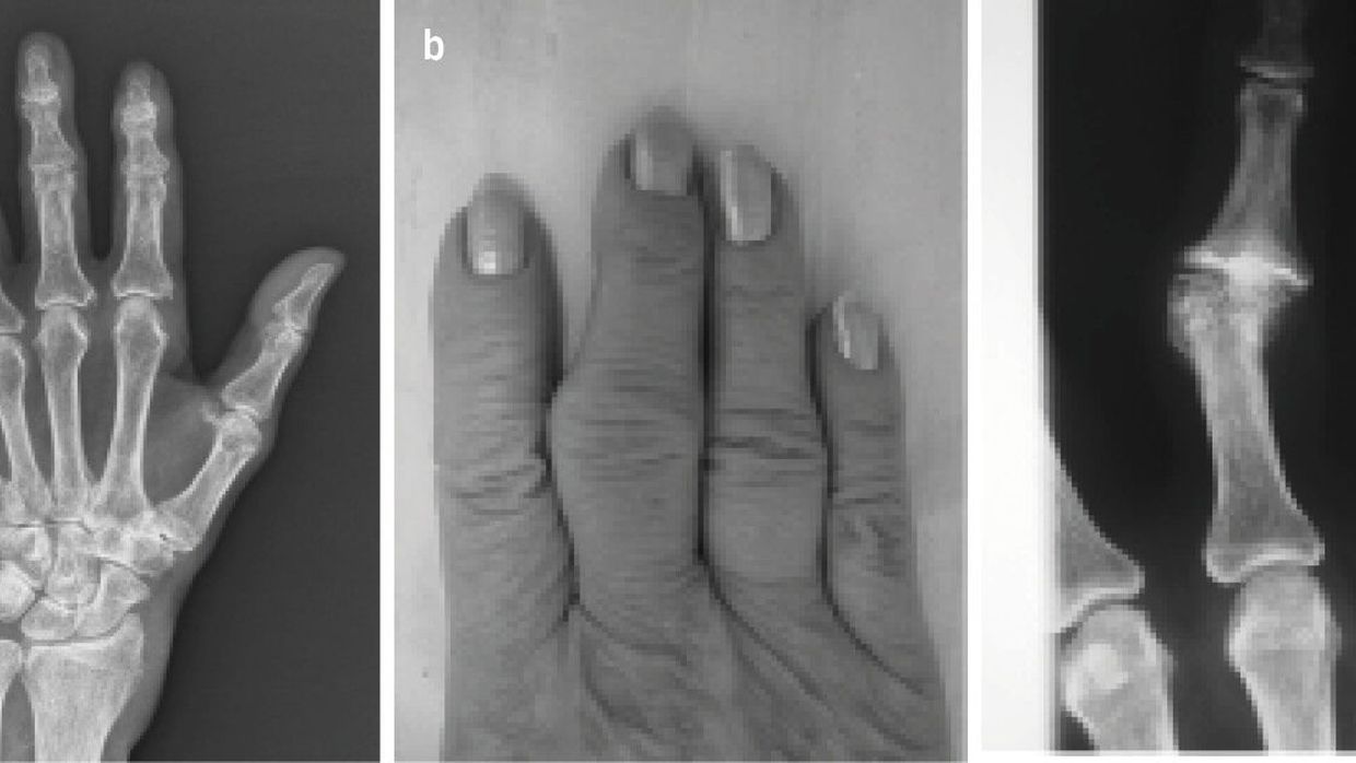 Versorgungskonzepte der PIP- und DIP-Arthrose - Orthopädie ...