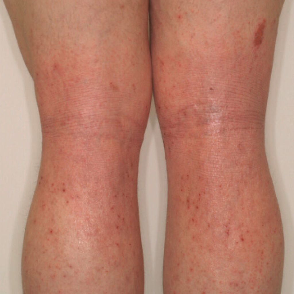 Wie gehen Dermatologen in der Praxis vor? - Dermatologie - Universimed ...