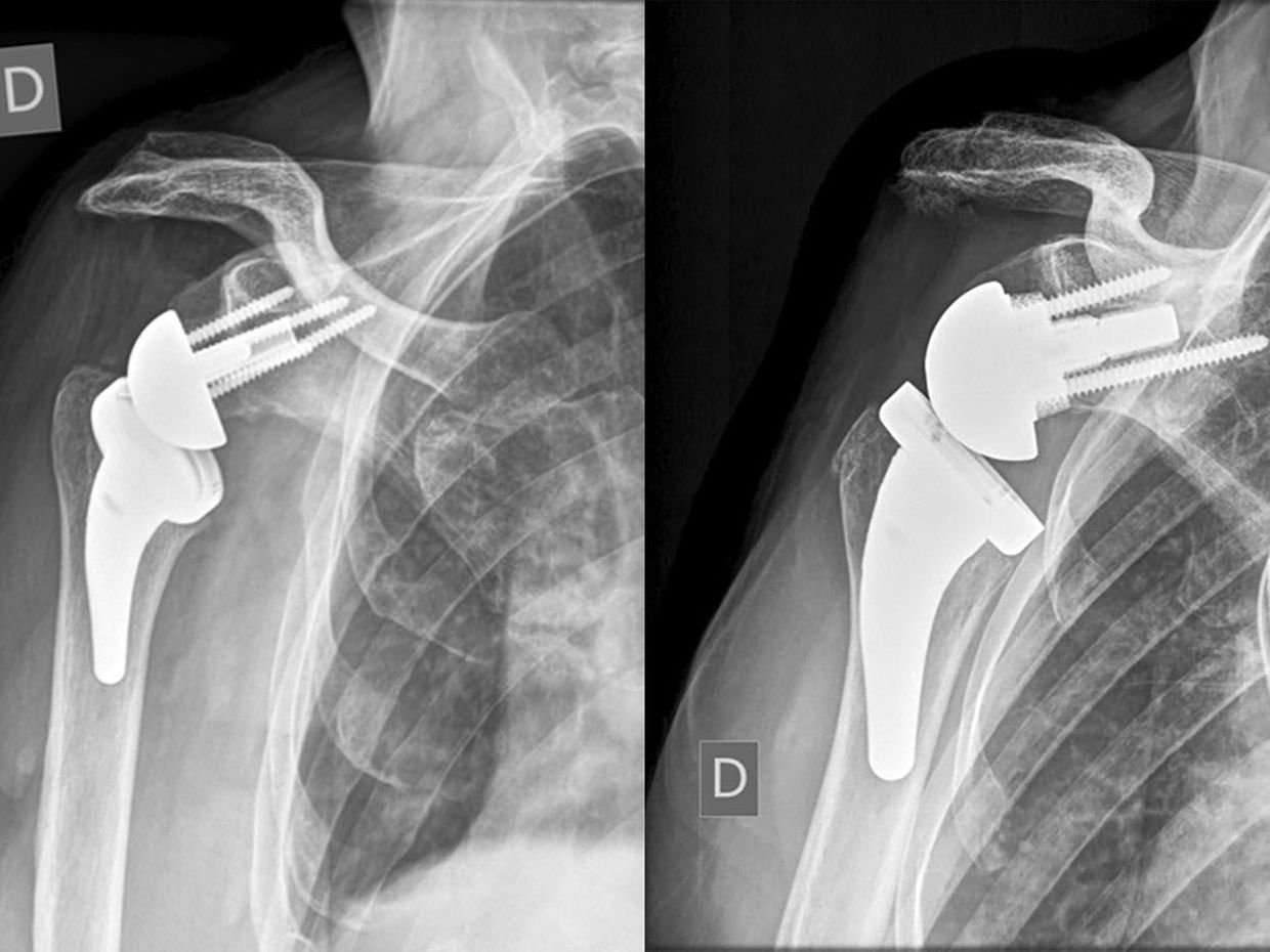 Patient-specific lateralization, glenoid offset, implications and oper ...