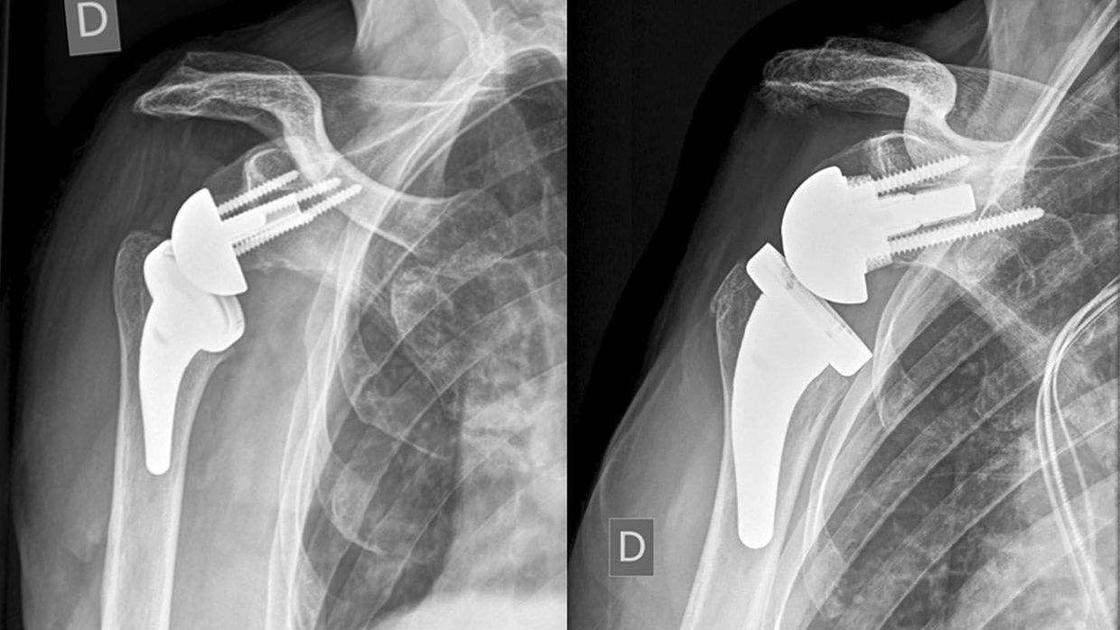 Patient-specific lateralization, glenoid offset, implications and oper ...