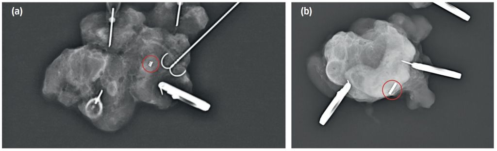 «Tailored/targeted axillary dissection» beim Mammakarzinom - Onkologie ...
