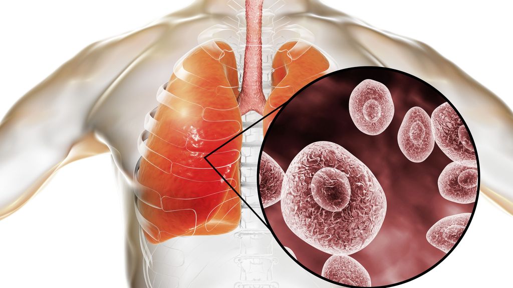 Muss man das Emphysem heute noch spezifischer beurteilen? - Pneumologie ...